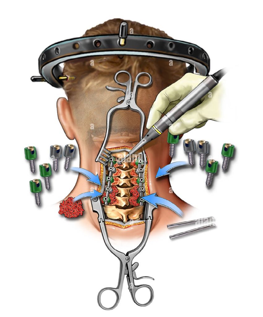 Cervical Discectomy Surgical Procedure - HealthBeauty123 | Your Health ...